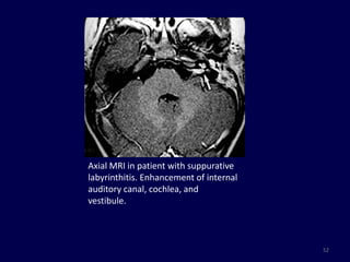 Internal Auditory Canal Mri