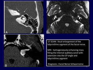 Internal Auditory Canal Mri