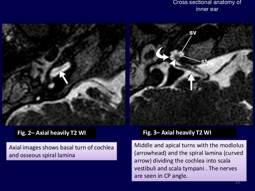 Magnetic Resonance Imaging Of Inner Ear