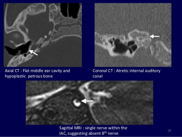 Magnetic Resonance Imaging Of Inner Ear