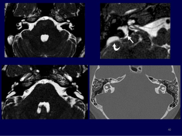 Magnetic Resonance Imaging Of Inner Ear