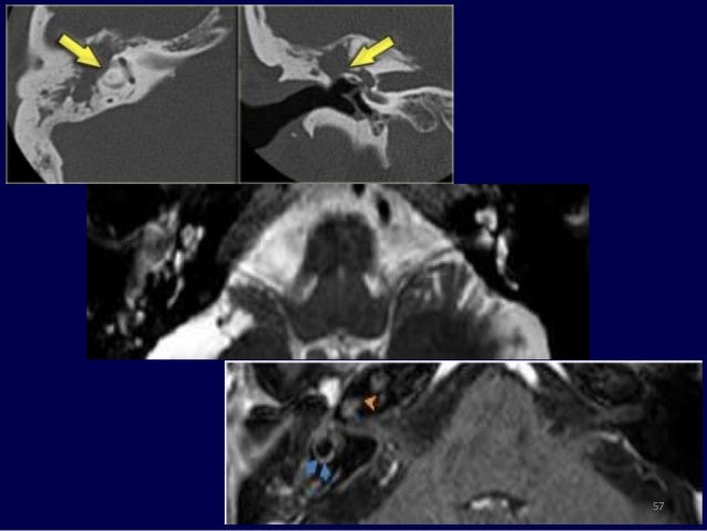 Magnetic Resonance Imaging Of Inner Ear
