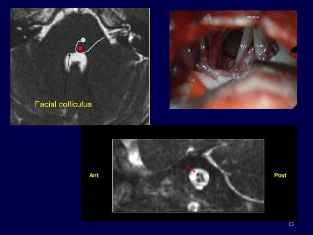 Magnetic Resonance Imaging Of Inner Ear