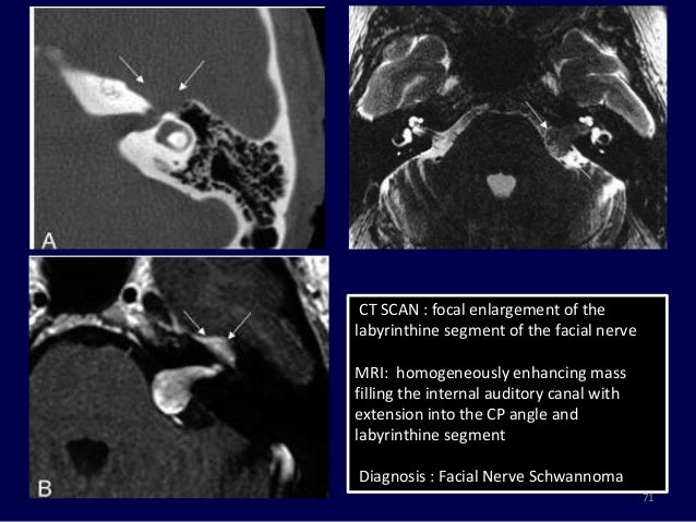 Magnetic Resonance Imaging Of Inner Ear