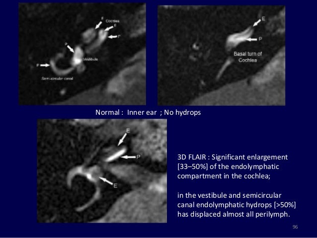Magnetic Resonance Imaging Of Inner Ear