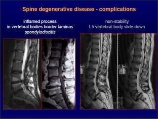 Lumbar Spine Mri Interpretation