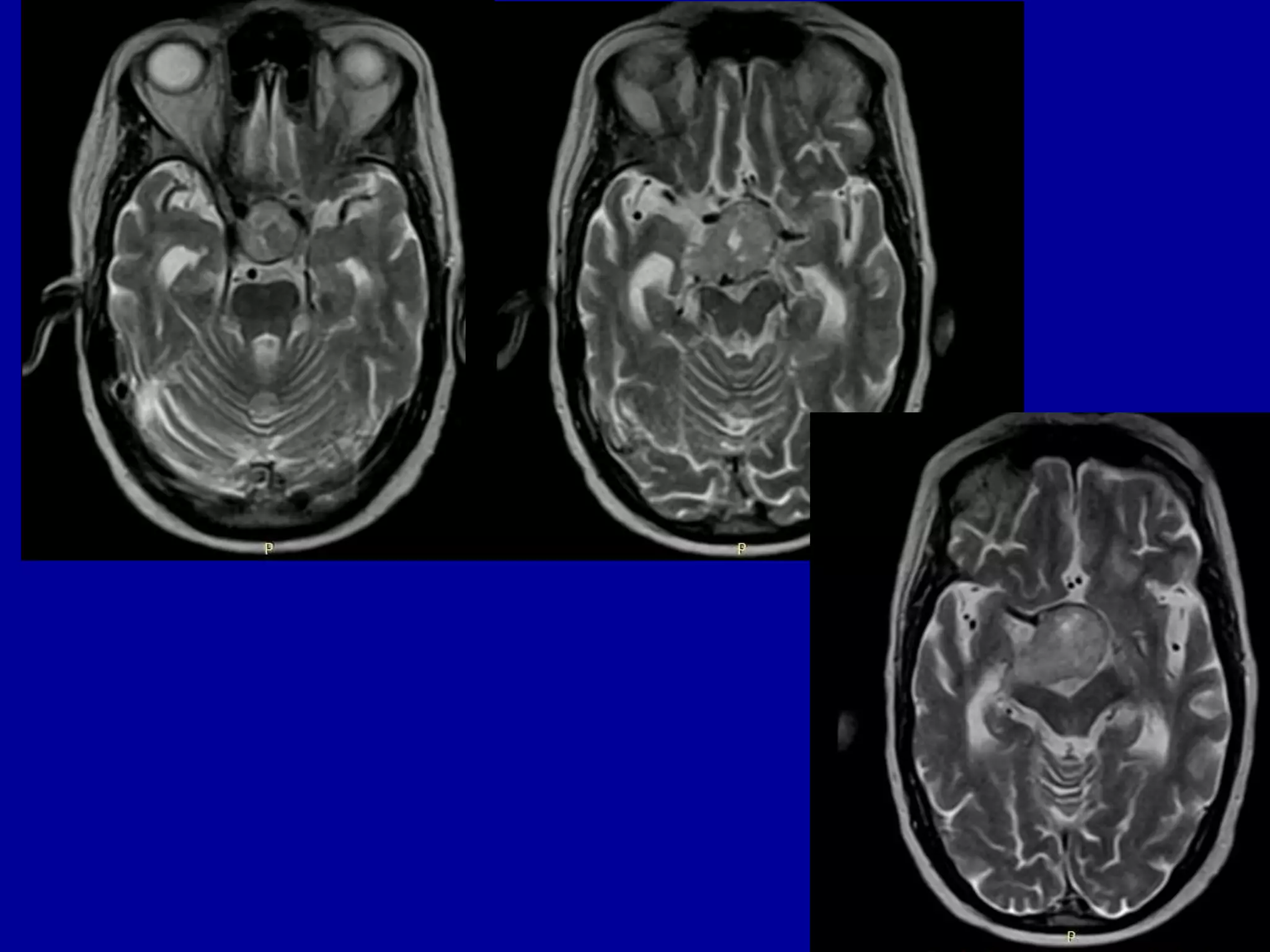 MRI CASE DISCUSSION---- MACROADENOMA, NEUROGENIC SPINAL TUMORS, SPINAL ...