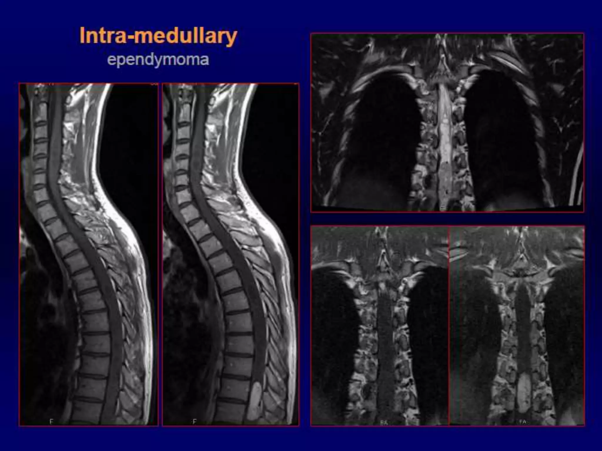 MRI CASE DISCUSSION---- MACROADENOMA, NEUROGENIC SPINAL TUMORS, SPINAL ...