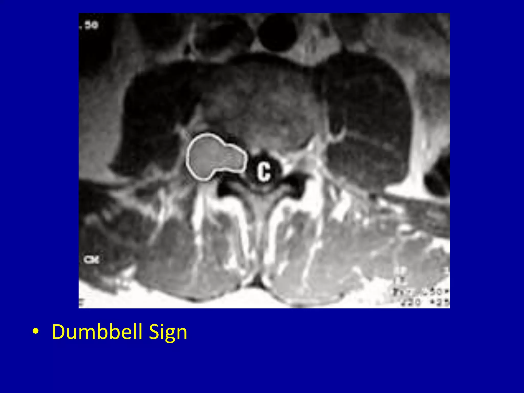 MRI CASE DISCUSSION---- MACROADENOMA, NEUROGENIC SPINAL TUMORS, SPINAL ...
