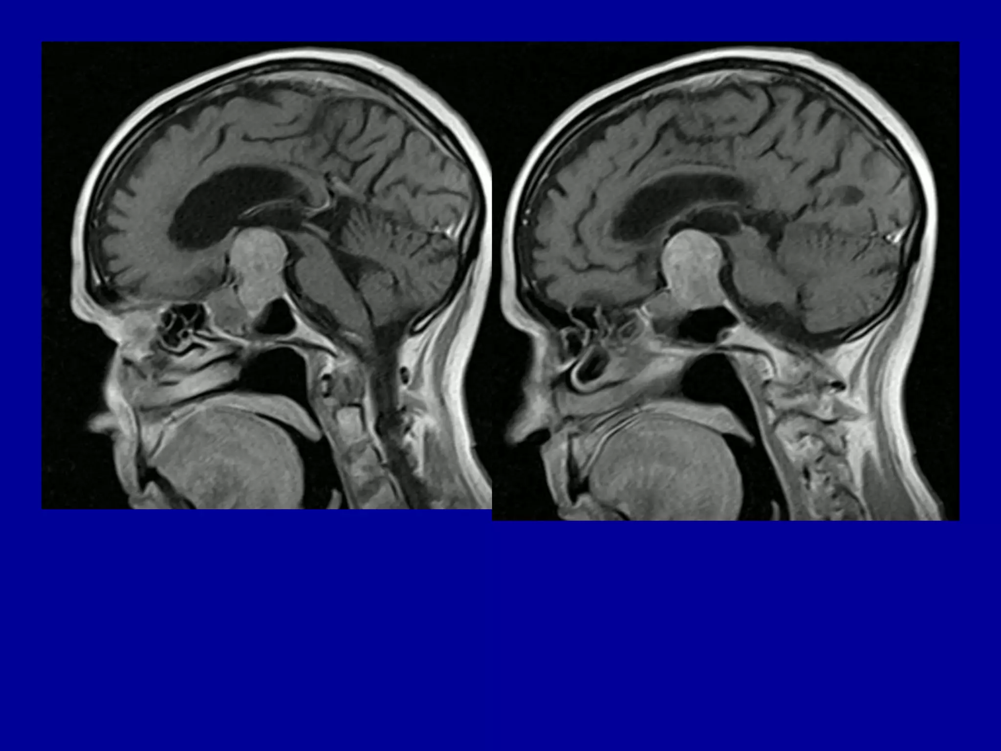 MRI CASE DISCUSSION---- MACROADENOMA, NEUROGENIC SPINAL TUMORS, SPINAL ...