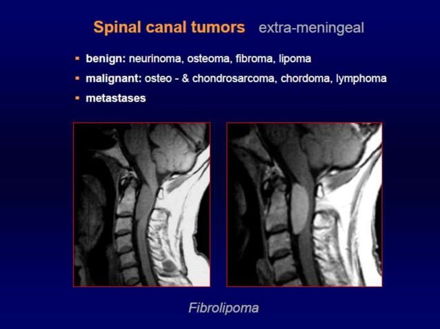 MRI CASE DISCUSSION---- MACROADENOMA, NEUROGENIC SPINAL TUMORS, SPINAL ...
