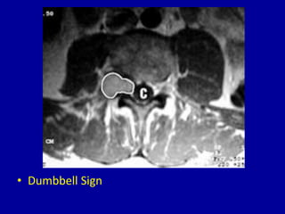 MRI CASE DISCUSSION---- MACROADENOMA, NEUROGENIC SPINAL TUMORS, SPINAL ...