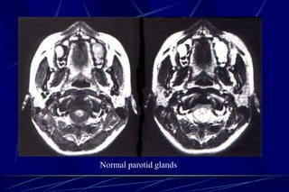 MRI magnetic resonance in head and neck | PPT