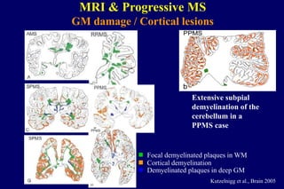 MRI markers to understand progression | PPT
