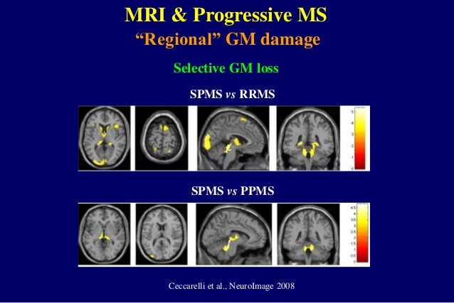 MRI markers to understand progression