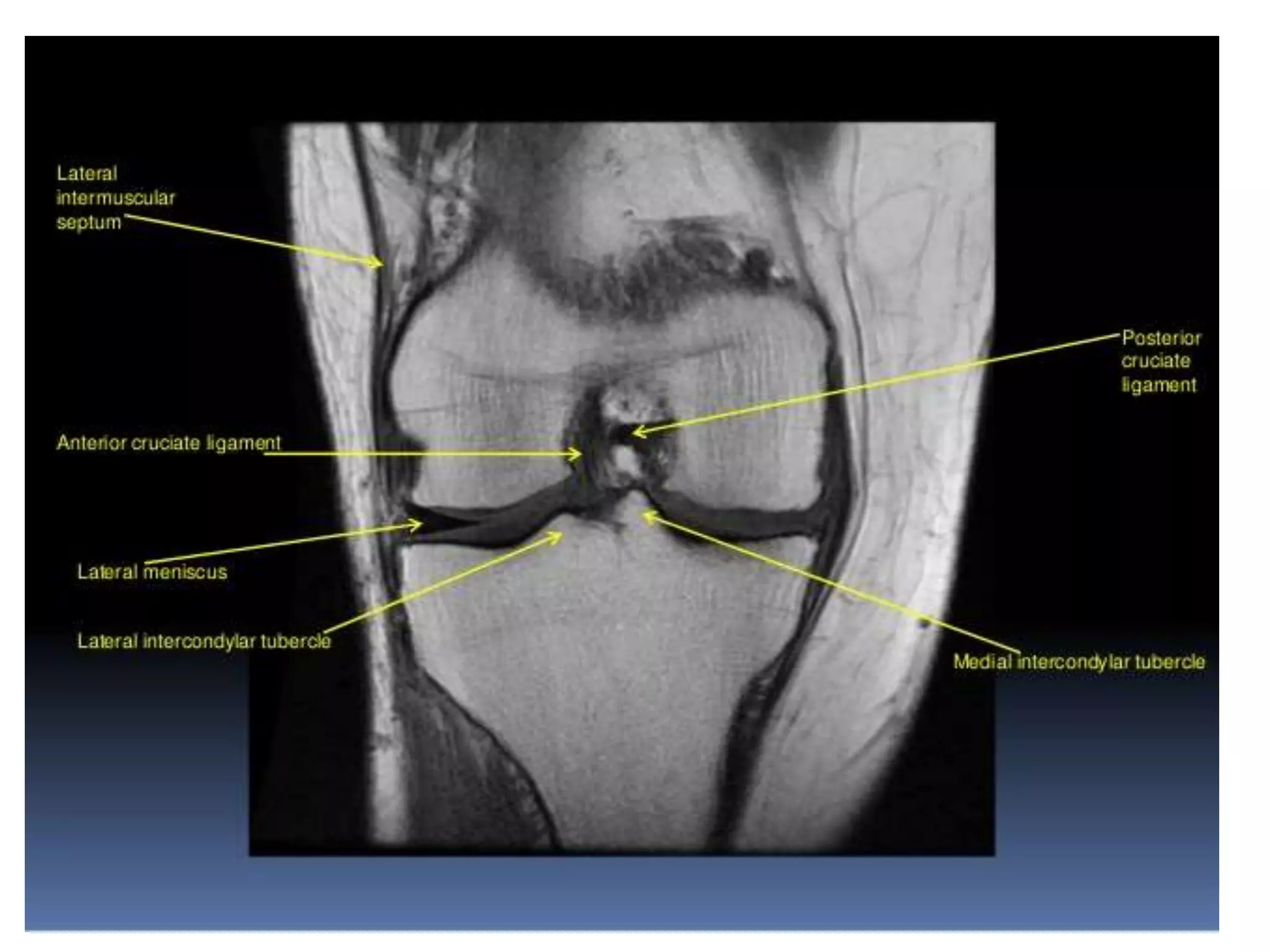 Mri musculoskeletal system | PPTX