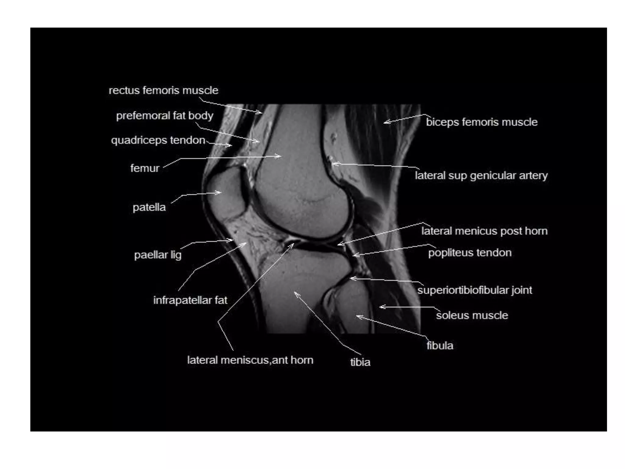 Mri musculoskeletal system | PPTX