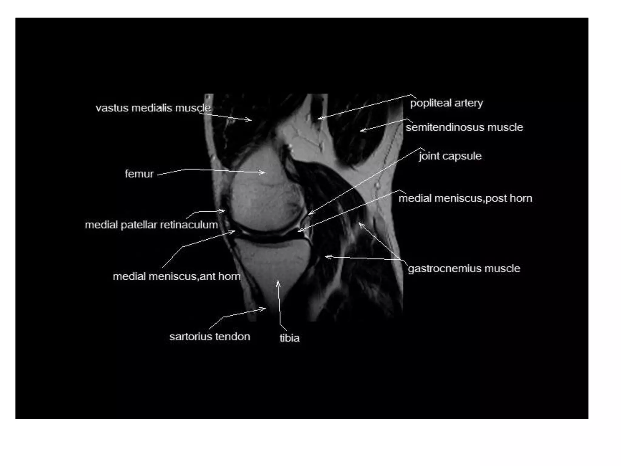 Mri musculoskeletal system | PPTX