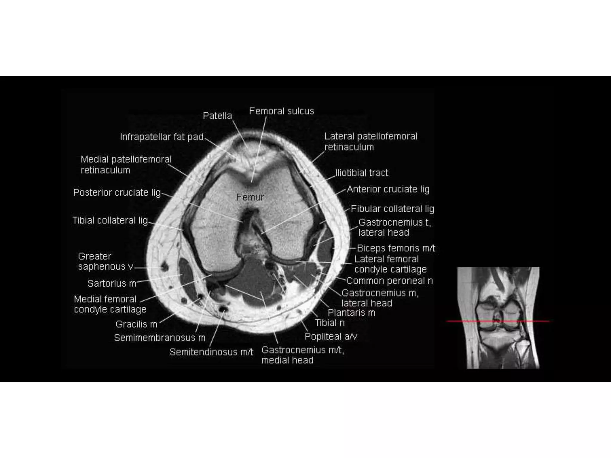 Mri musculoskeletal system | PPTX
