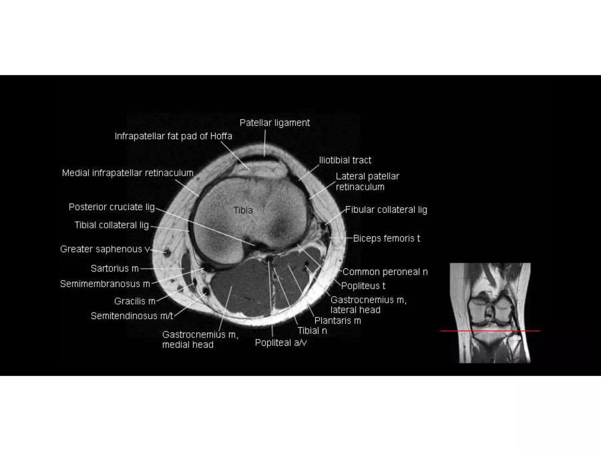 Mri musculoskeletal system | PPTX