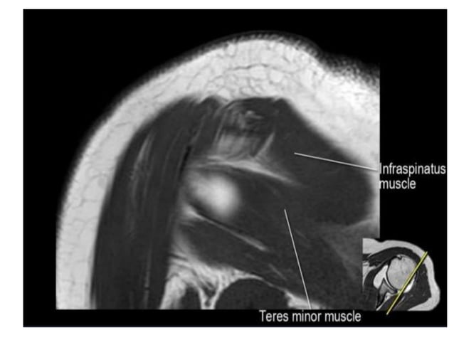Mri musculoskeletal system | PPTX