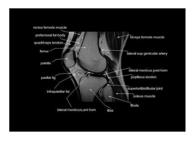 Mri musculoskeletal system | PPTX