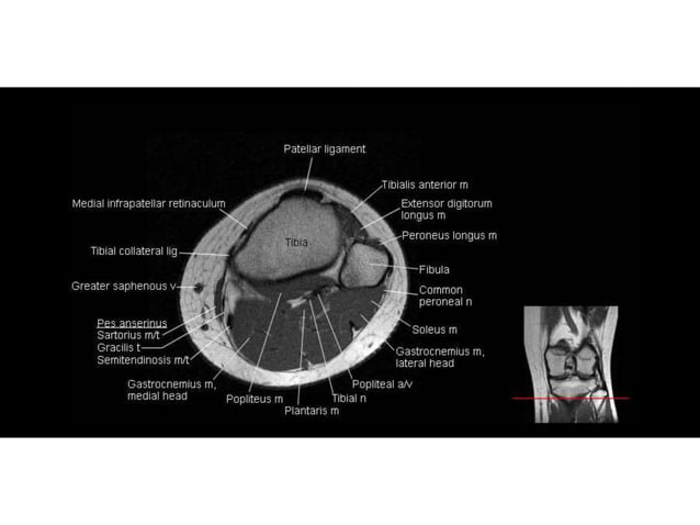 Mri musculoskeletal system | PPTX