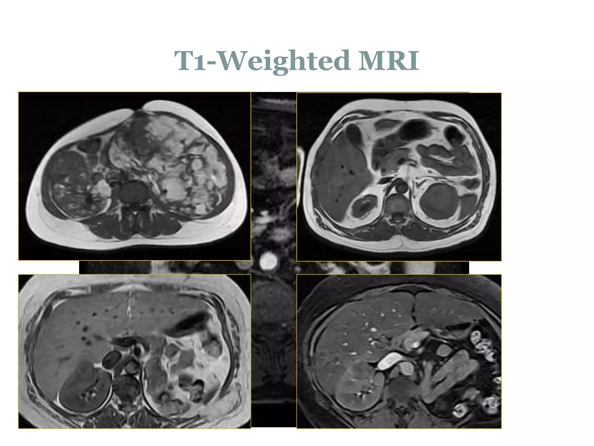 Mri nephrology 2017 | PPTX