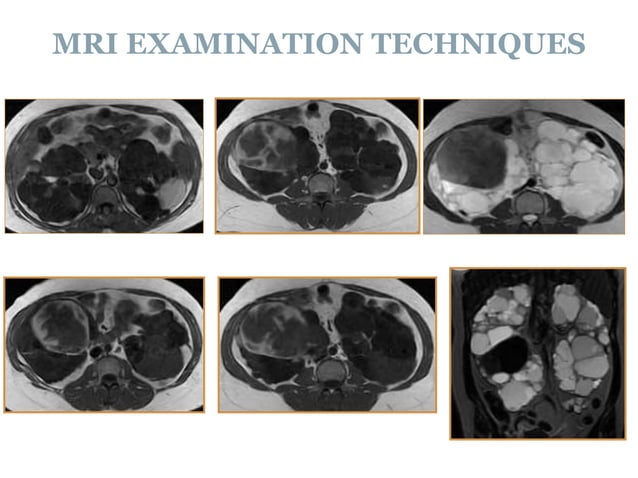 Mri nephrology 2017 | PPTX | Medical Tests | Medical Health