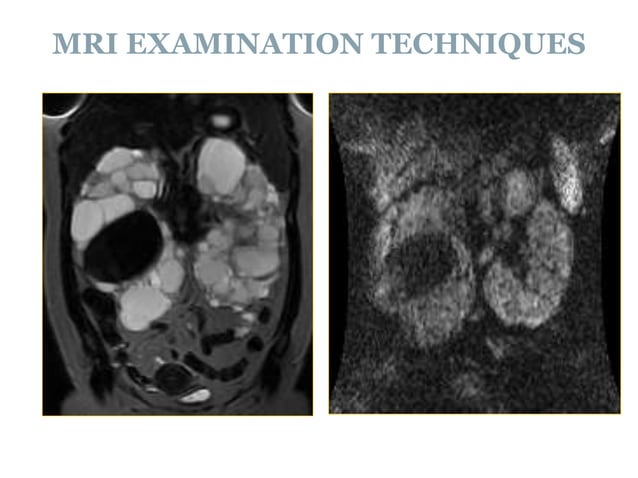 Mri nephrology 2017 | PPTX | Medical Tests | Medical Health