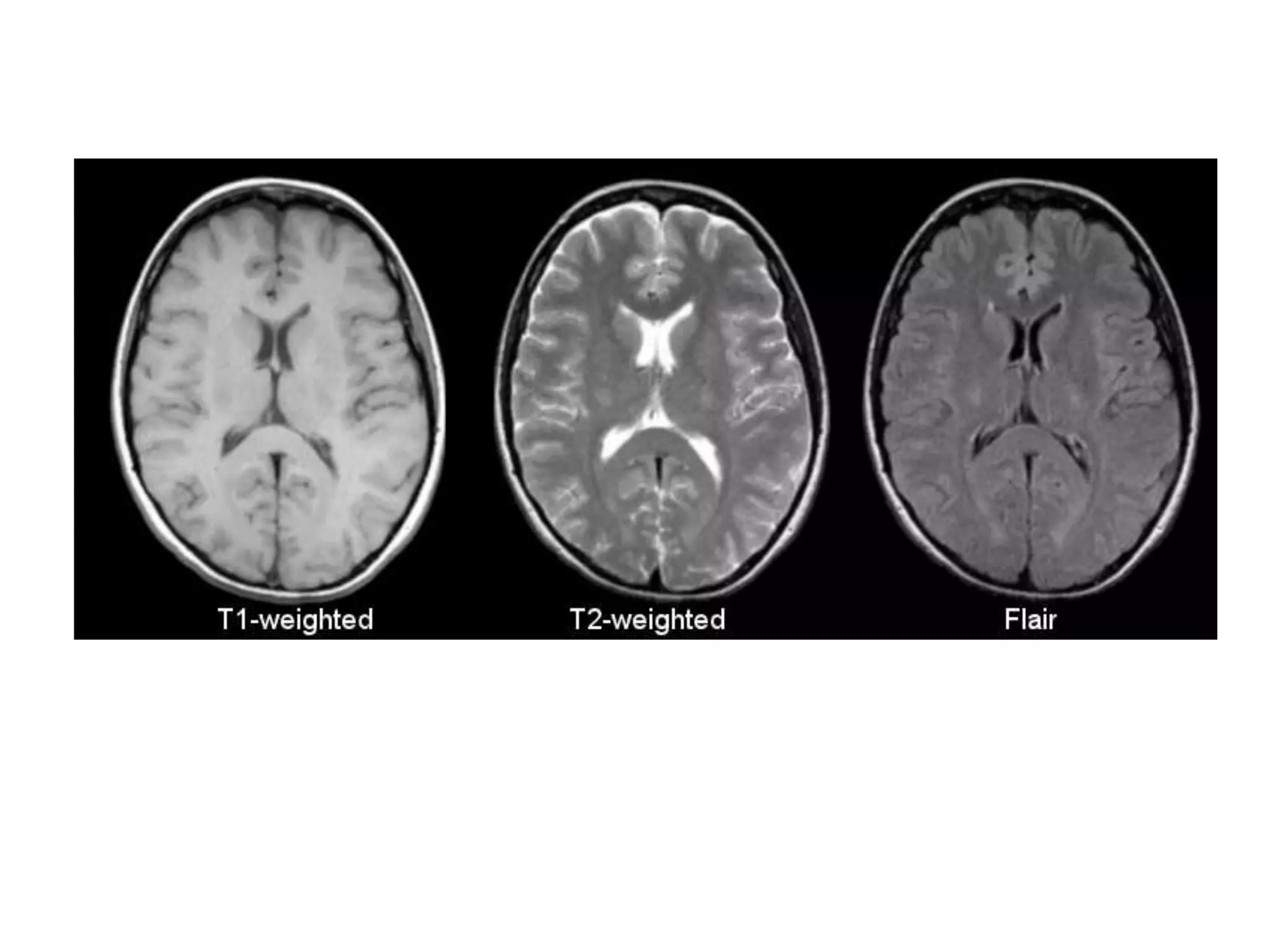 MRI of Brain: Basics | PPTX | Brain and Nervous System Disorders ...