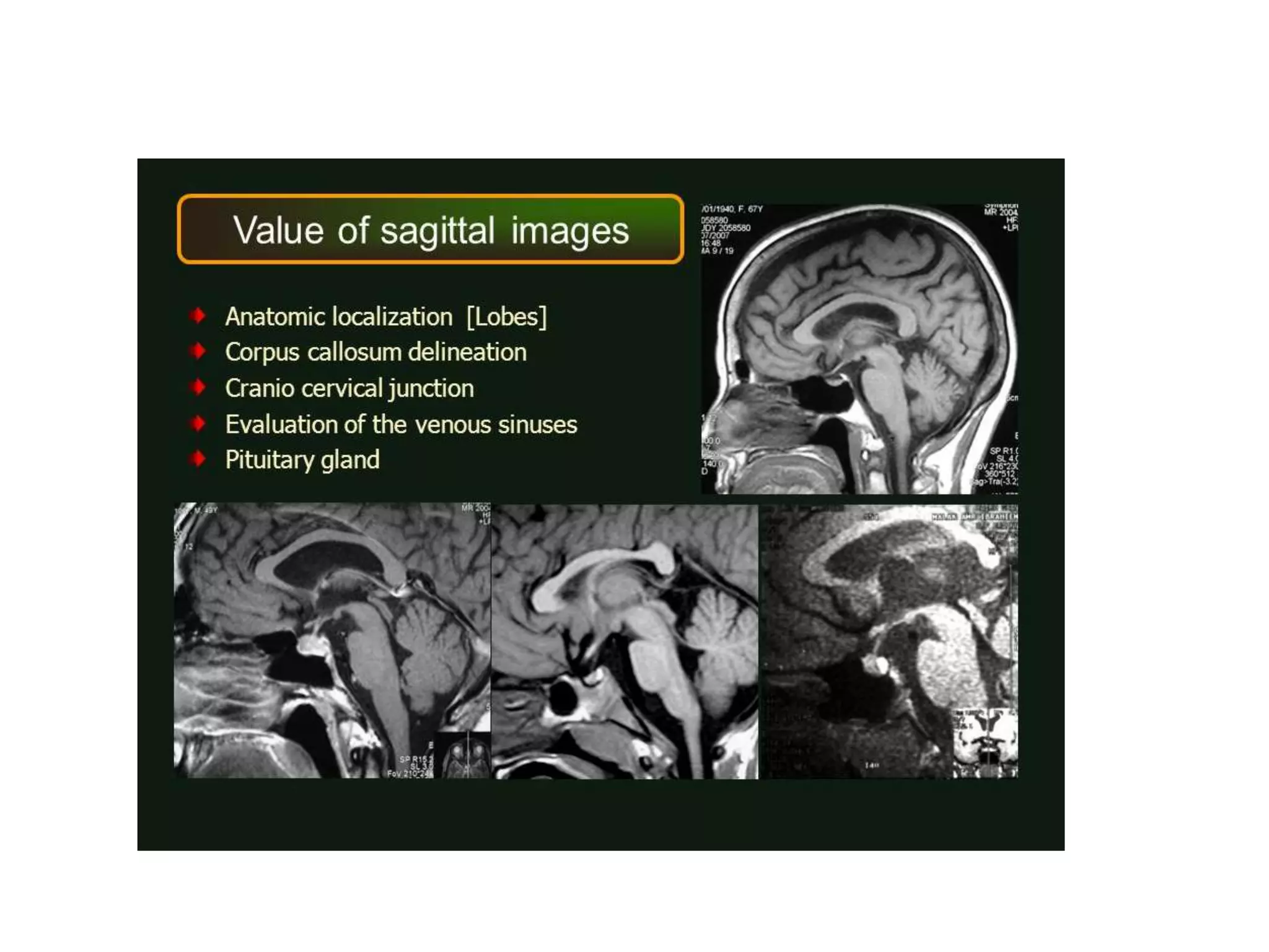 MRI of Brain: Basics | PPTX