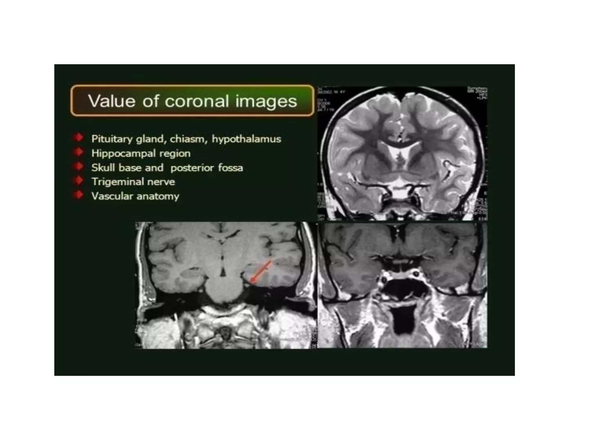 MRI of Brain: Basics | PPTX