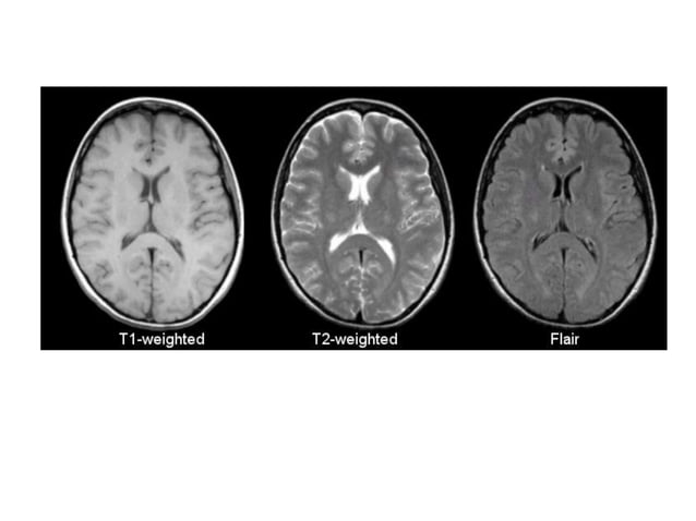 MRI of Brain: Basics | PPTX | Brain and Nervous System Disorders | Diseases and Conditions