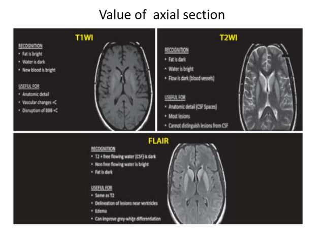 MRI of Brain: Basics | PPTX | Brain and Nervous System Disorders | Diseases and Conditions