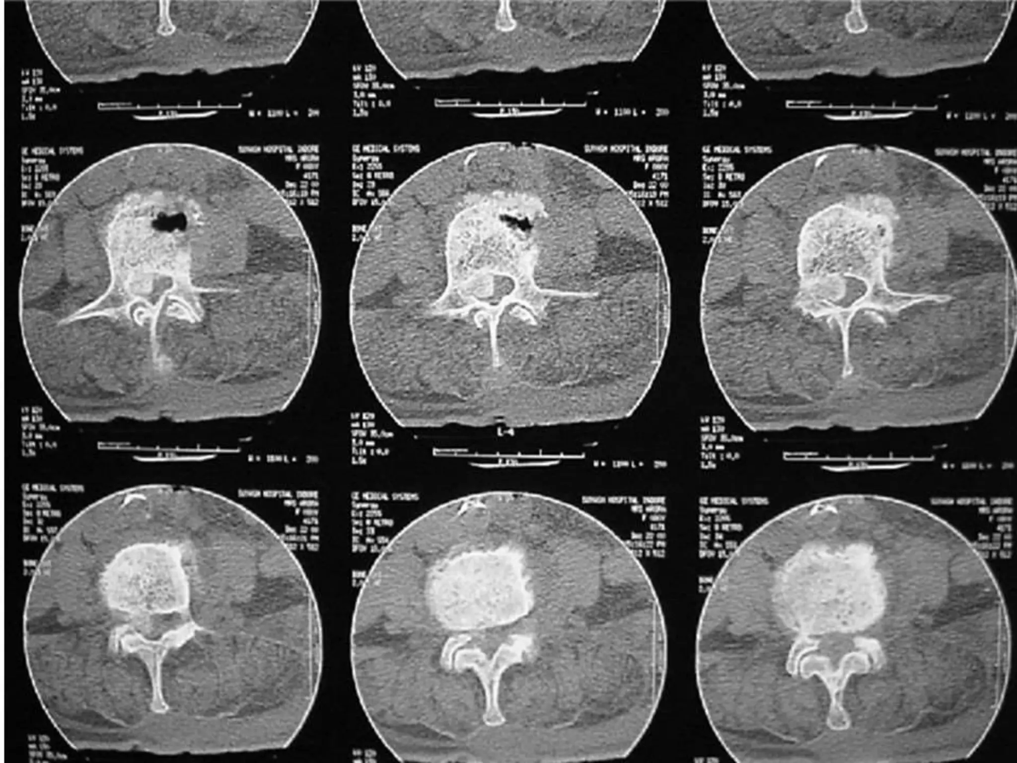 MRI of Interesting Rare Spinal Cases.pptx