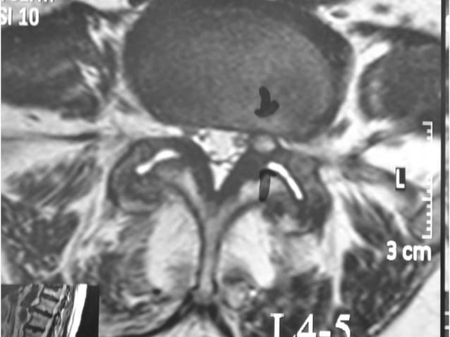 MRI of Interesting Rare Spinal Cases.pptx