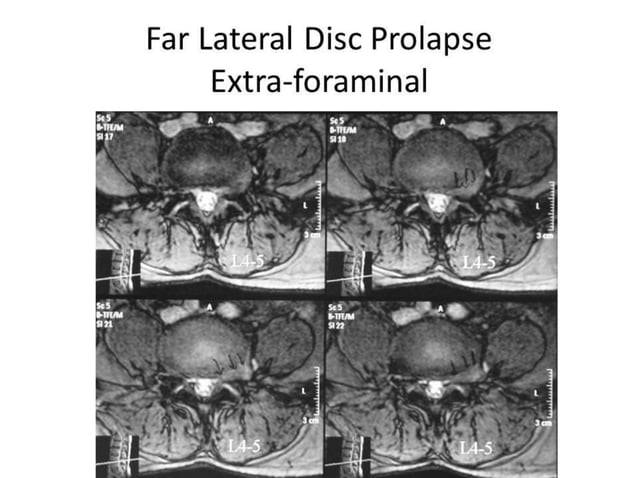 MRI of Interesting Rare Spinal Cases.pptx