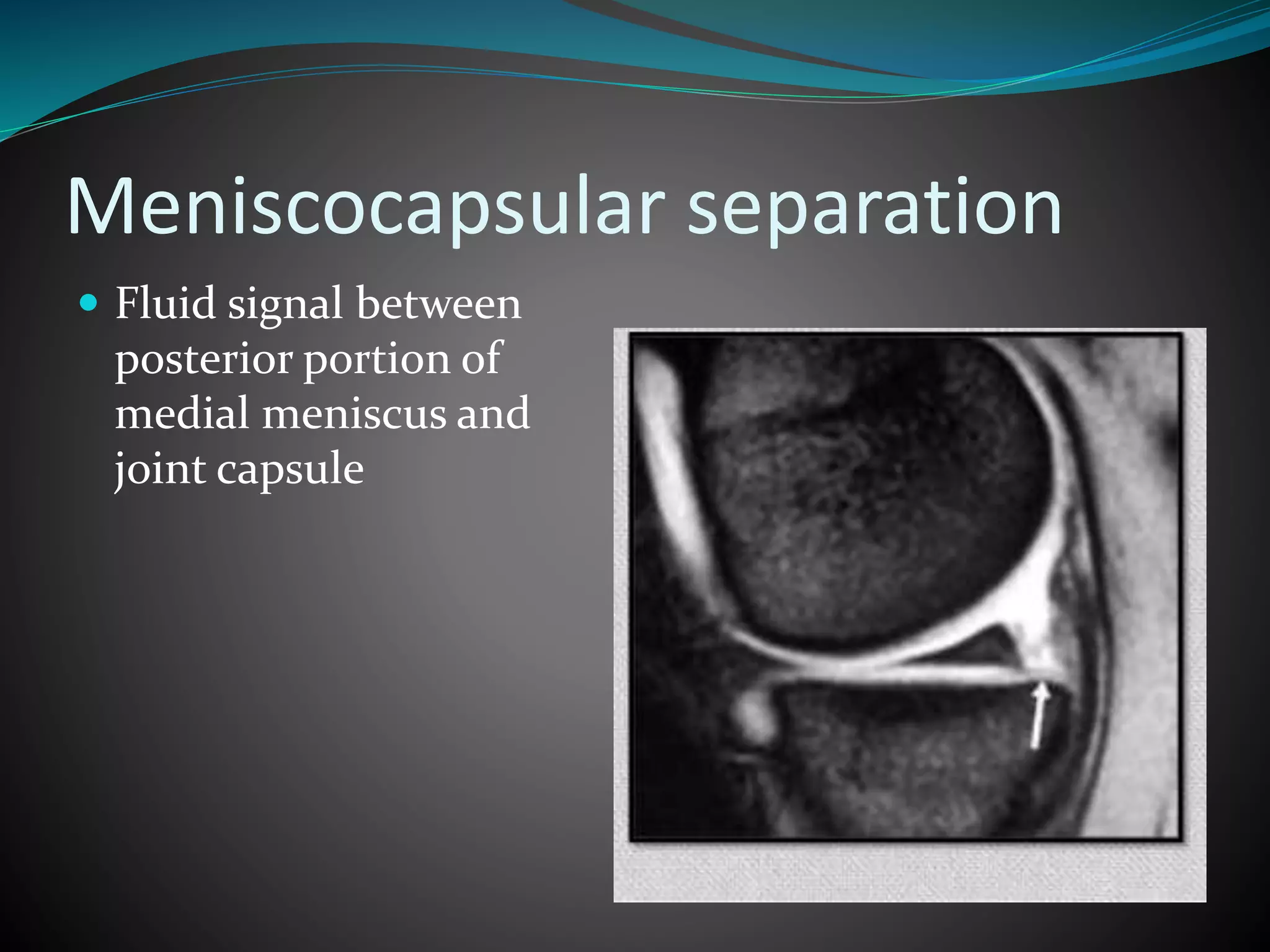 Mri of knee | PPTX