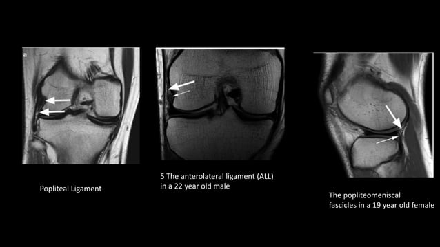 MRI OF KNEE JOINT.pptx