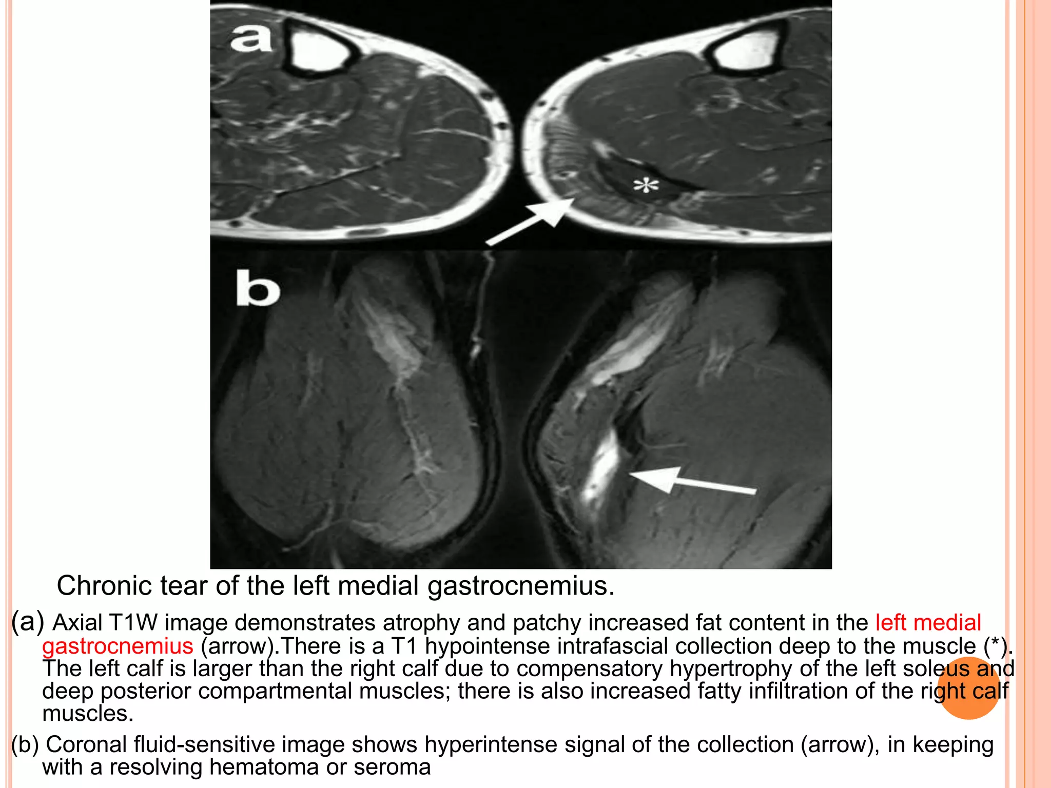 Mri of muscle diseases | PPTX