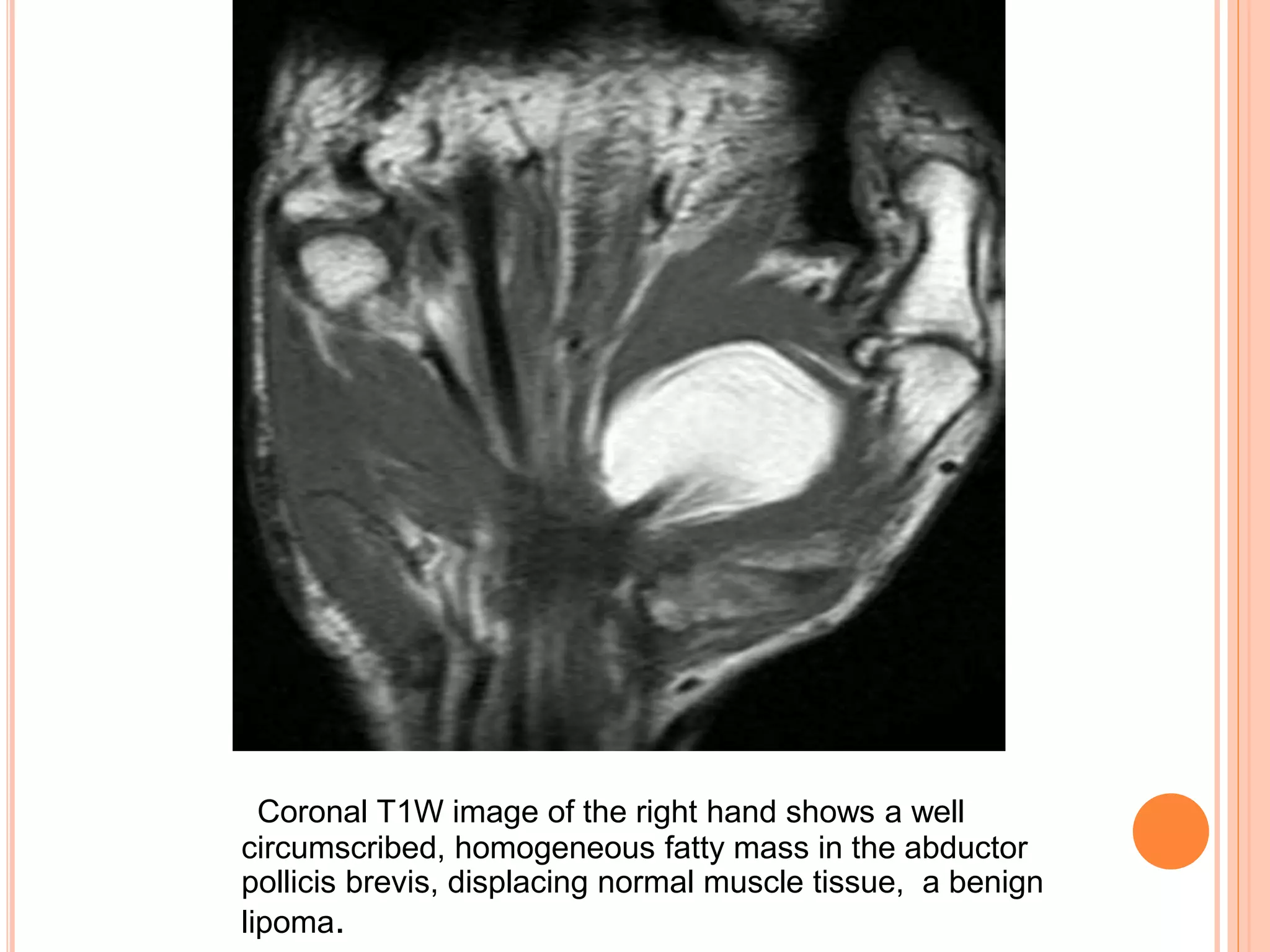 Mri of muscle diseases | PPTX