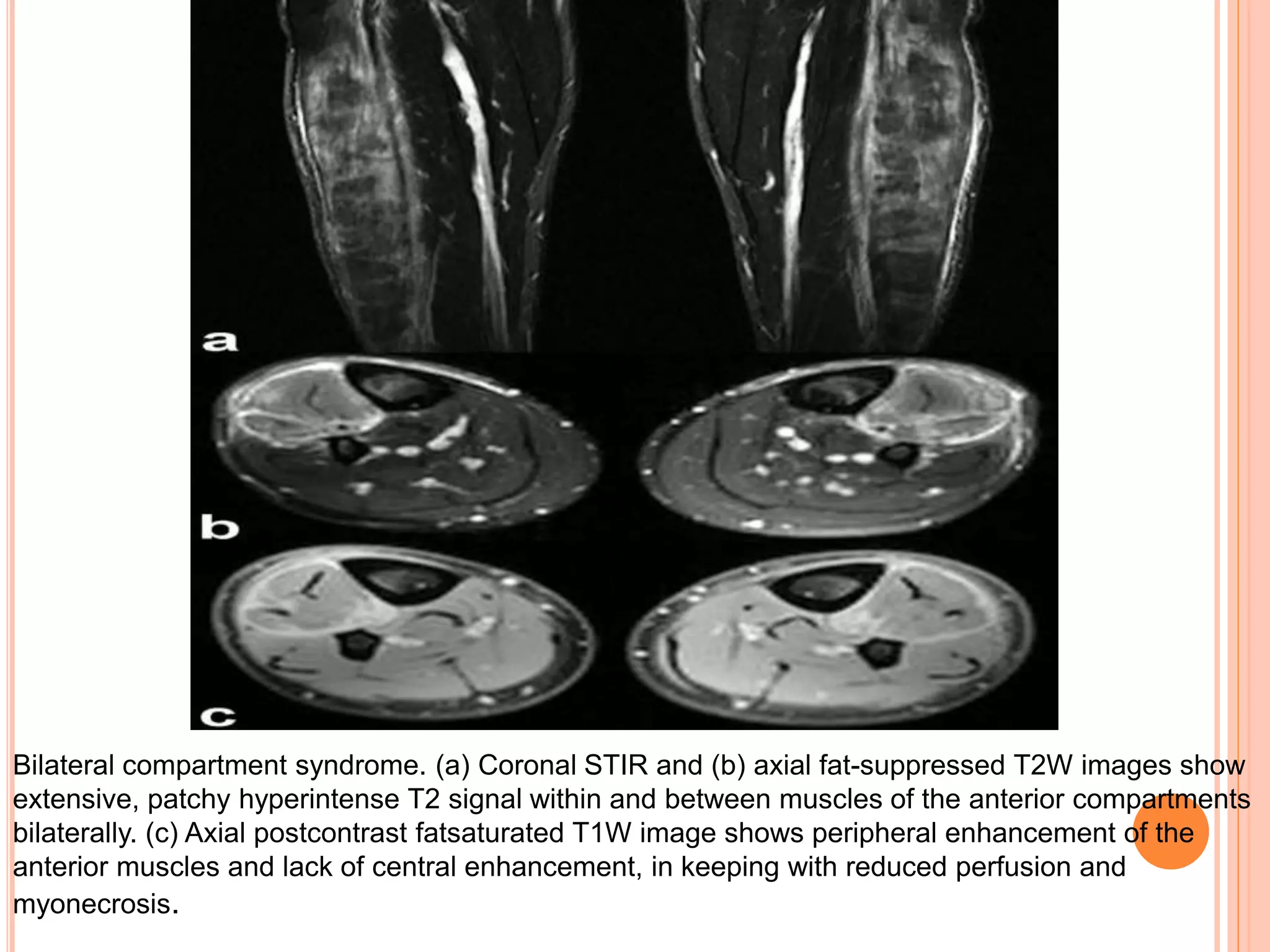 Mri of muscle diseases | PPTX