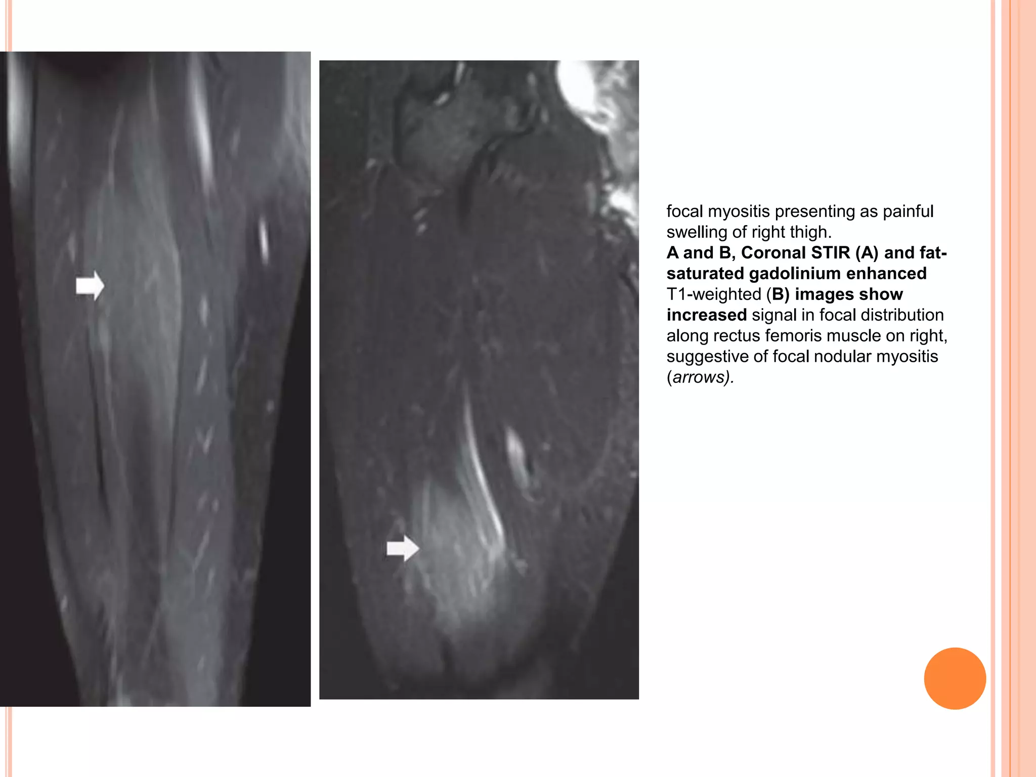 Mri of muscle diseases | PPTX