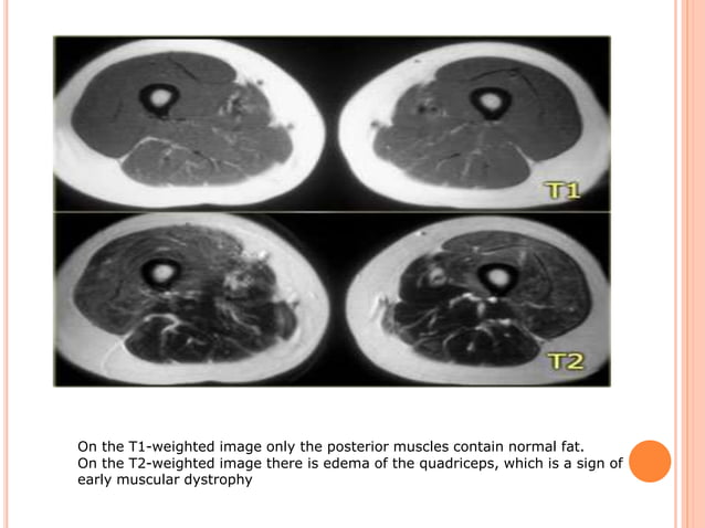 Mri of muscle diseases | PPTX
