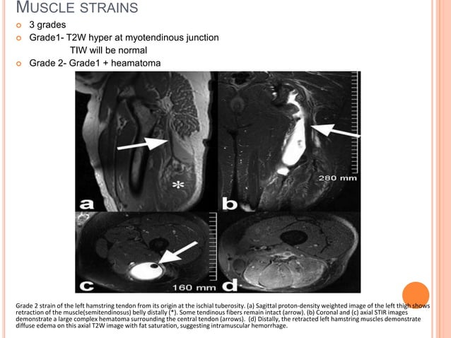 Mri of muscle diseases | PPTX