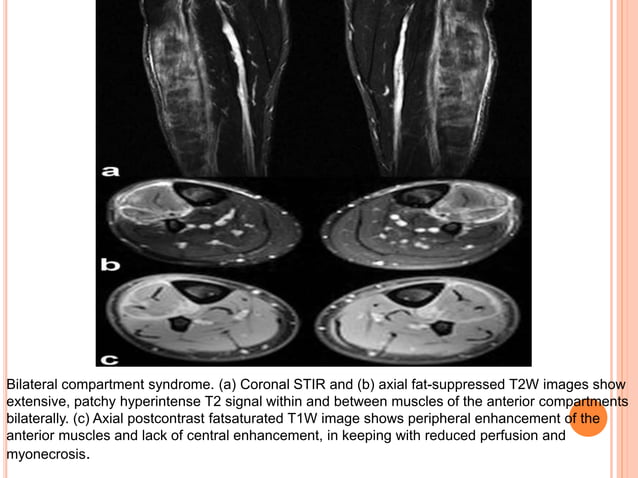 Mri of muscle diseases | PPTX