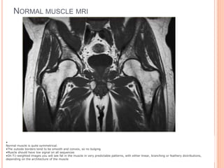 Mri of muscle diseases | PPTX