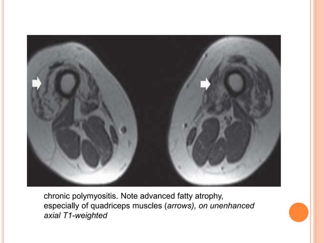 Mri of muscle diseases | PPTX