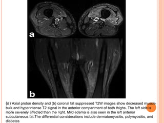 Mri of muscle diseases | PPTX